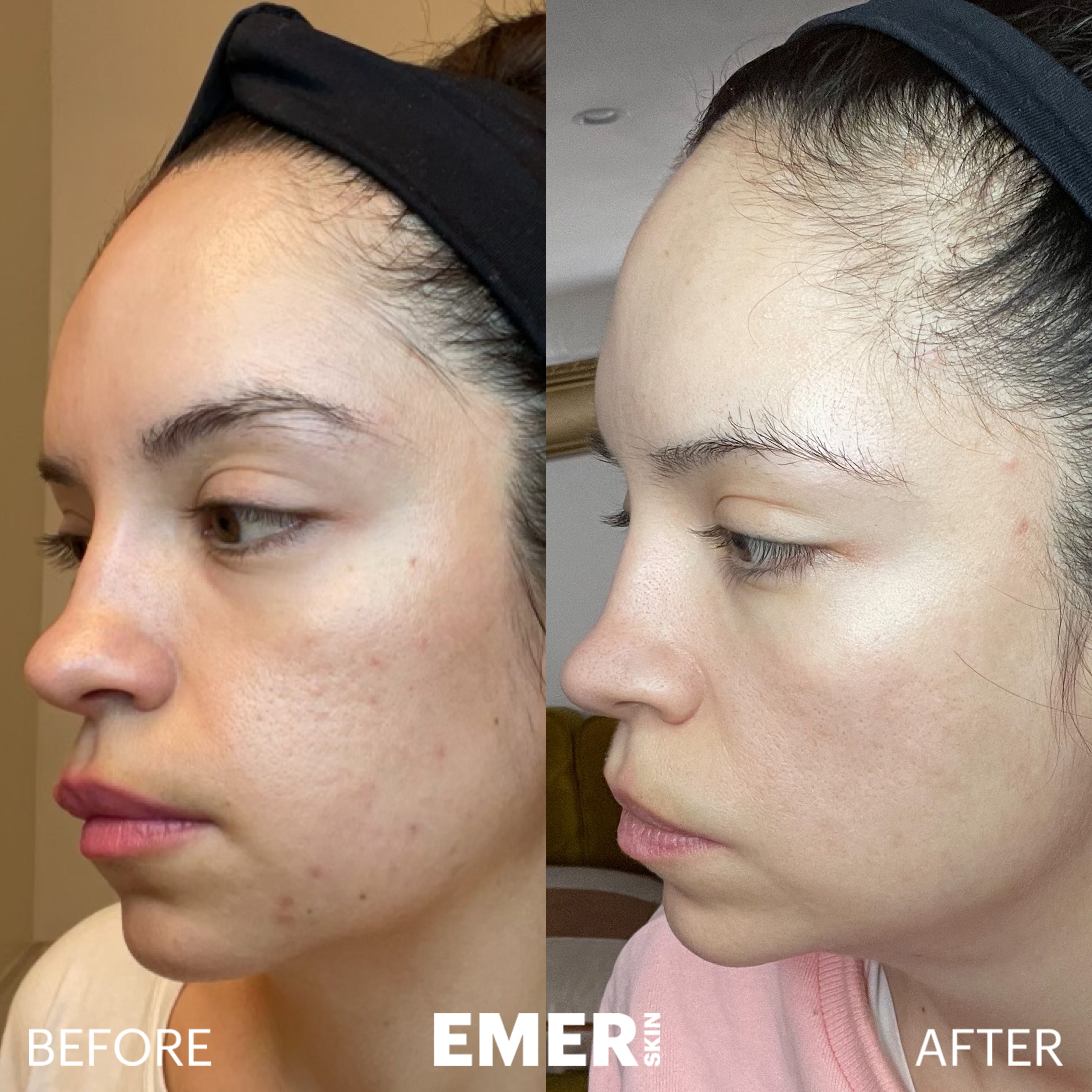Dermergency Micro-Peel Complexion Kit | Emer Skin